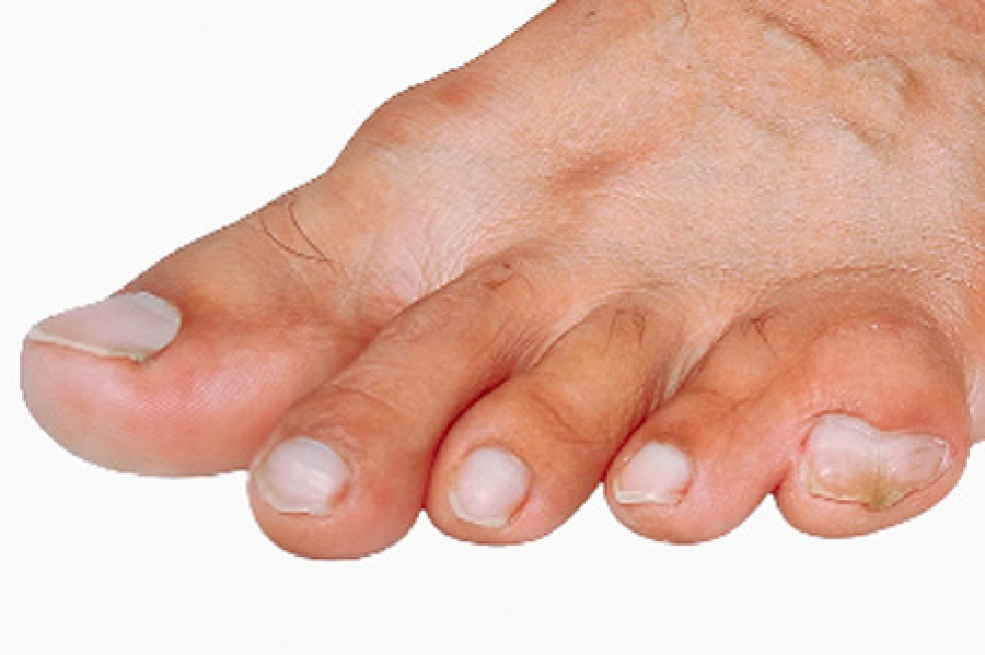 Definition and Causes of Webbed Toes